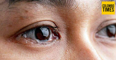 දිවයින පුරා පැතිර යන ඇස් රෝගයක් ගැන අනතුරු ඇඟවීමක්